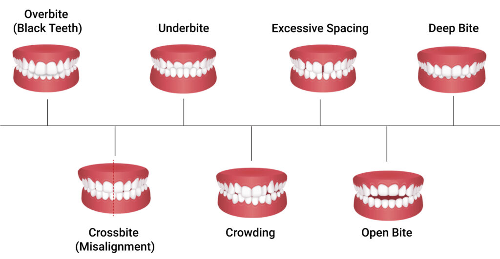 How Misalignment or Malocclusion Teeth Can Impact Your Child?