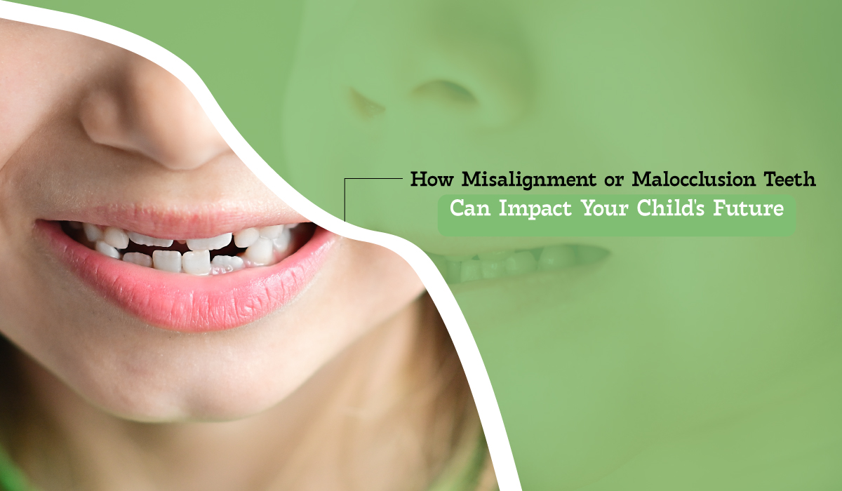 How Misalignment or Malocclusion Teeth Can Impact Your Child?