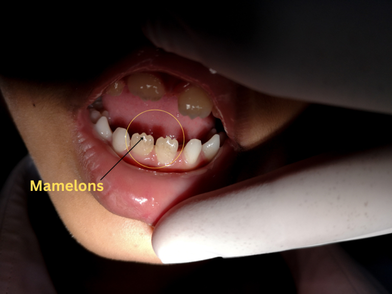 Mamelons On baby Teeth: What Are These & How To Treat Them